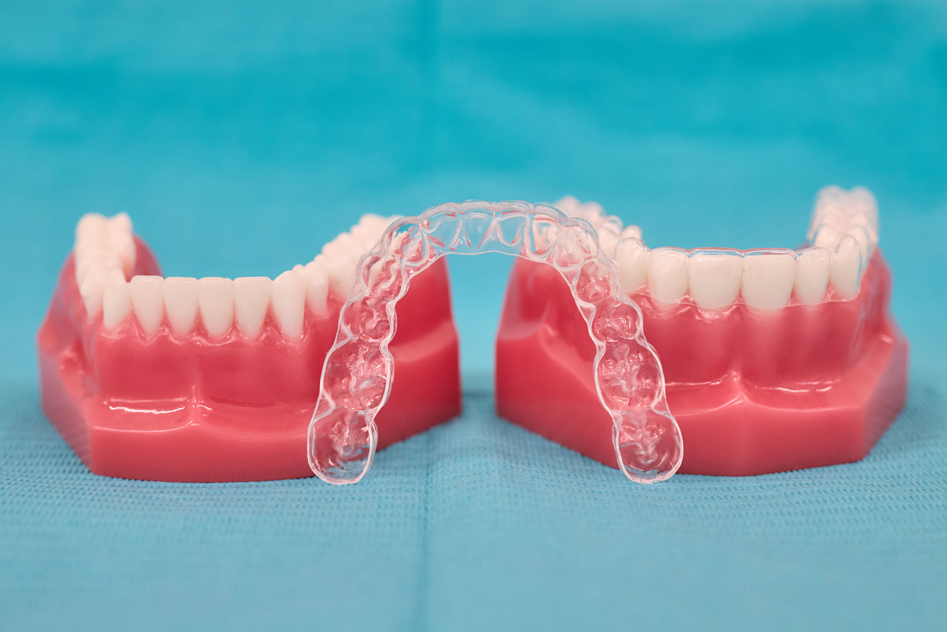 Vaste beugel of aligner? - Van 't Veen Orthodontie